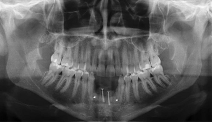 Knochenaufbau und Bone-Management für Überweiser » MKG Rhein-Neckar ...